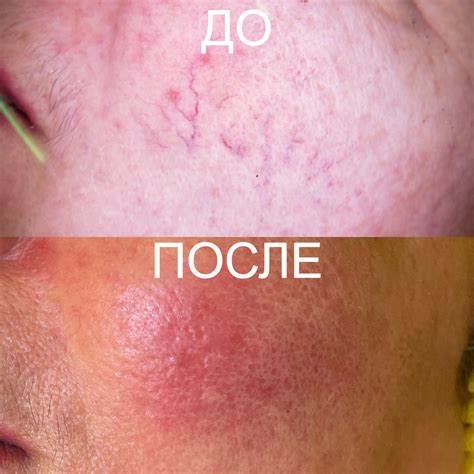 Лазерное удаление сосудов на лице в Минске, цена в medart.by