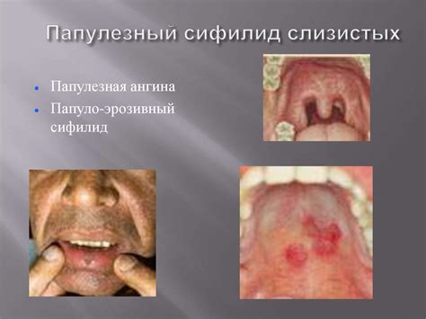 Сифилис. Исторические аспекты - презентация онлайн