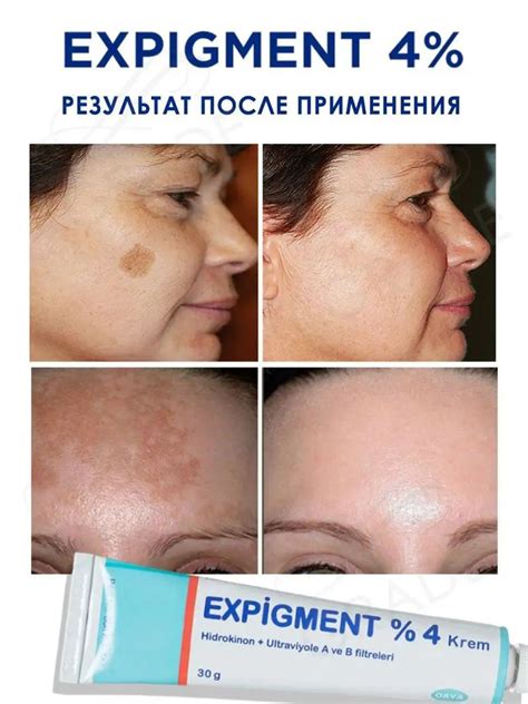 Expigment 4% Крем . Против темных и солнечных пятен на коже 30г ...