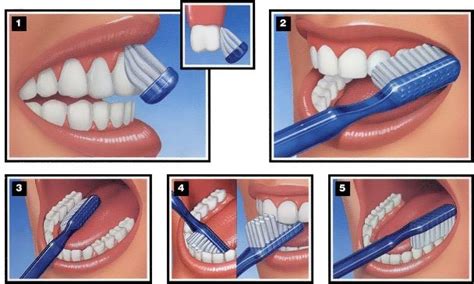 Charter Brushing Method: Enhancing Oral Hygiene Techniques - Dentist Decode
