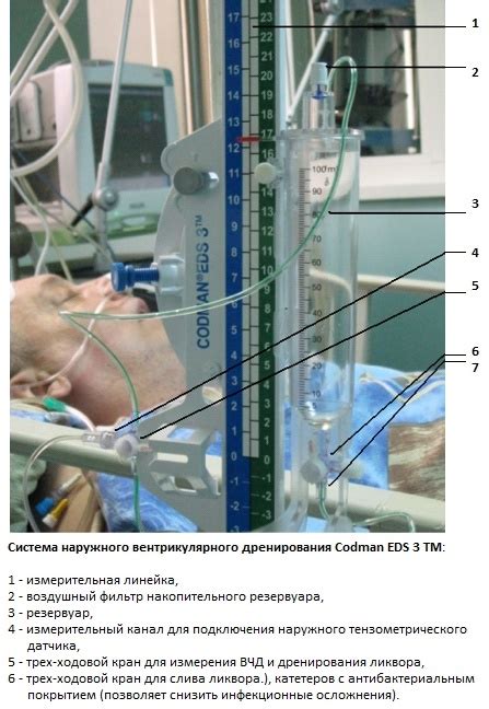 Мониторинг внутричерепного давления: инвазивные методики: laesus_de ...