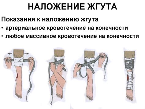 Кровотечение. Методы остановки кровотечений - презентация онлайн