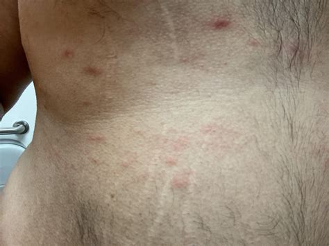 Weird rash appearing : r/DermatologyQuestions