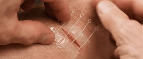 ZipStitch: An Alternative to Stitching Yourself Up – Preps Life