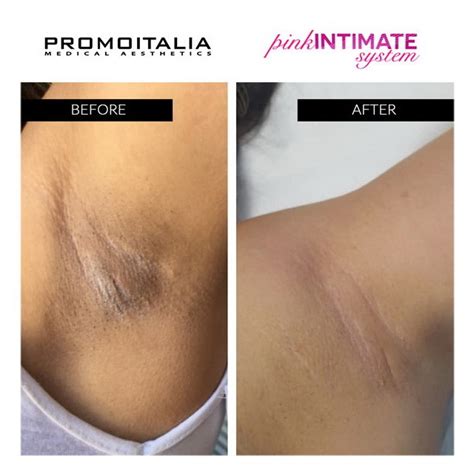 Pink Intimate System | Инновационная пилинг-система для отбеливания и ...