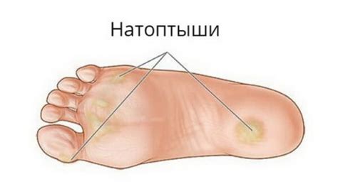 Мозоль на пятке: причины, виды, лечение
