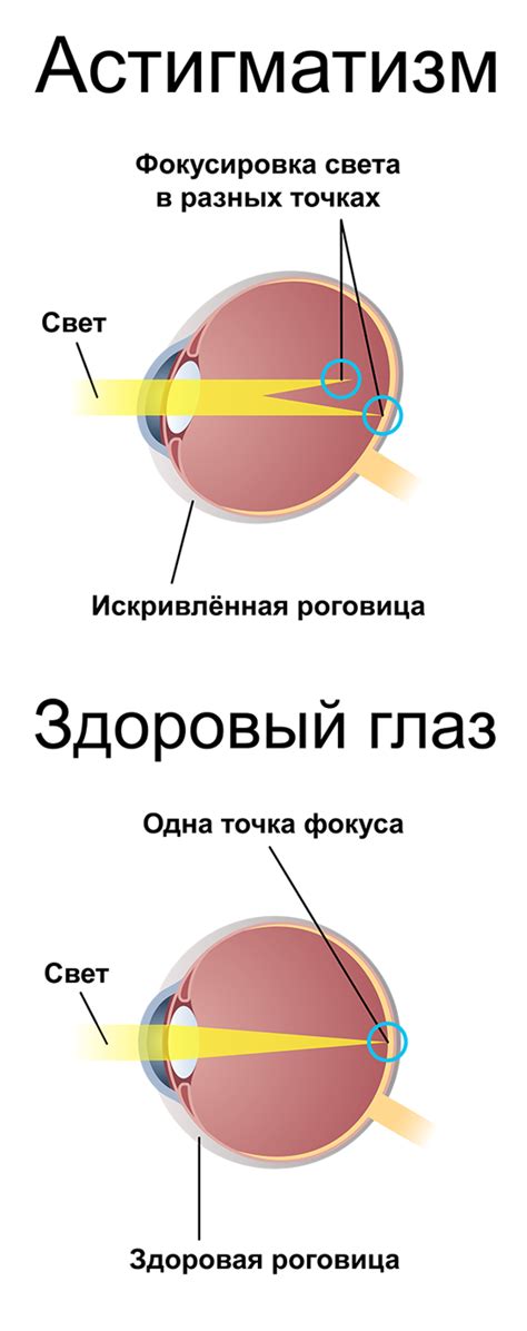 Лечение астигматизма глаз, методы лечения астигматизма | Глаукома.ру