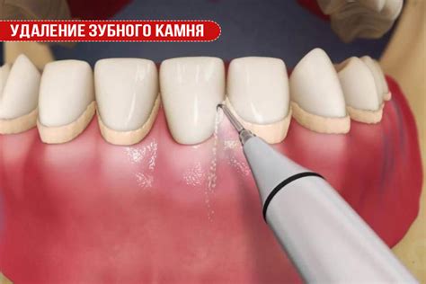 Удаление зубного камня | Статьи стоматологии в Николаеве