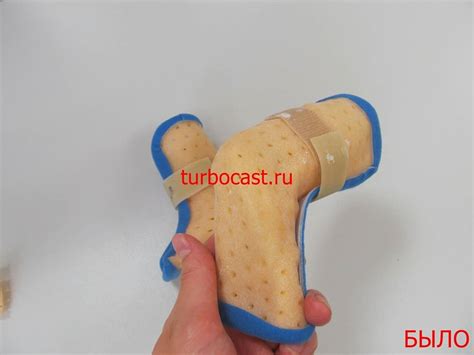 Турбокаст. Материал для внешней иммобилизации. Ортезирование при ДЦП ...