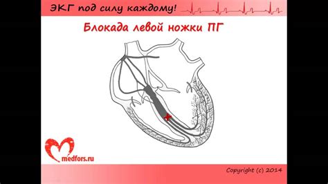 Урок 7 Видеокурс ЭКГ под силу каждому - YouTube