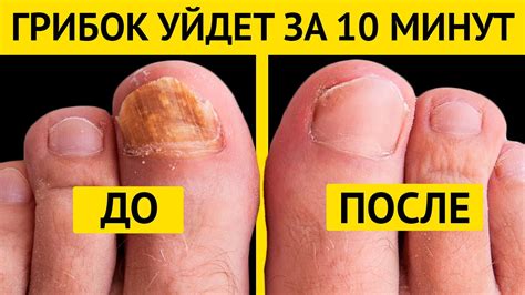 ГРИБОК НОГТЕЙ быстро исчезнет, если 10 минут в день применять эти ...