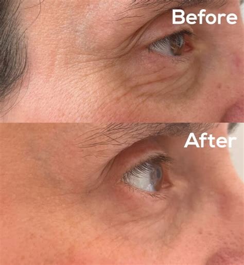 Исчезающие маски с сухой сывороткой DrySerum