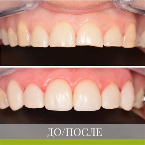 Композитные и керамические виниры: в чем разница?