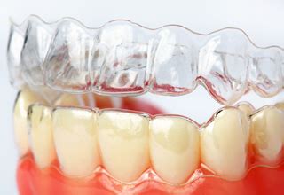 Ортодонтическое лечение каппами invisalign в Grand Dent | Grand Dent ...
