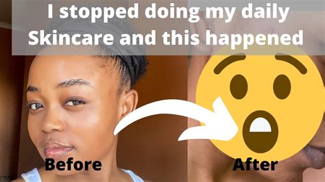 No Acne/Darkspot Skincare Products For A Week & I’m Shocked || My Acne ...