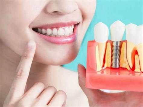 Мелочи жизни | Какие поставить импланты зубов | Dental implants, Dental ...