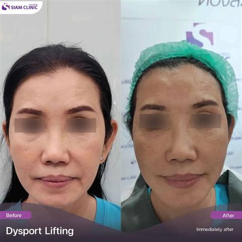 Review Botox Обзор случаев инъекций ботокса - Siam Clinic Phuket ...