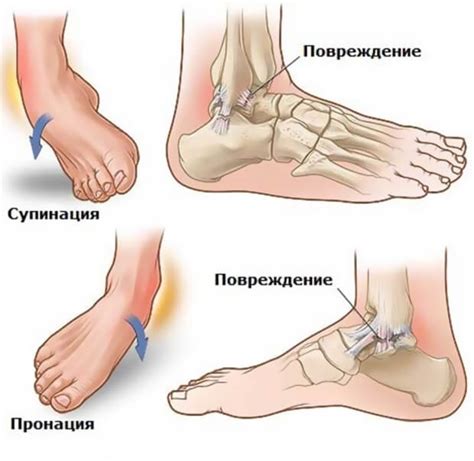Растяжение связок голеностопа: лечение и последствия