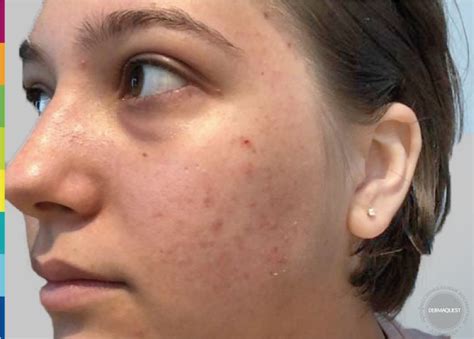 DERMAQUEST » Каким пилингом лучше убрать постакне| Статьи | Отзывы | Купить