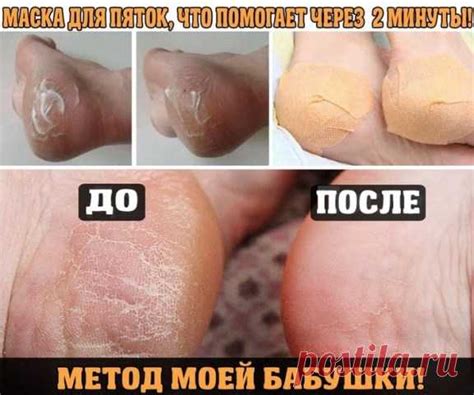 МАСКА ДЛЯ ПЯТОК, ЧТО ПОМОГАЕТ ЧЕРЕЗ 2 МИНУТЫ! Если трещины на пятках вы ...
