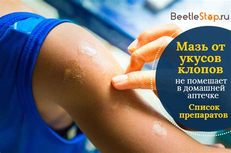 Мазь от укусов постельных клопов для человека: 5 лучших средств