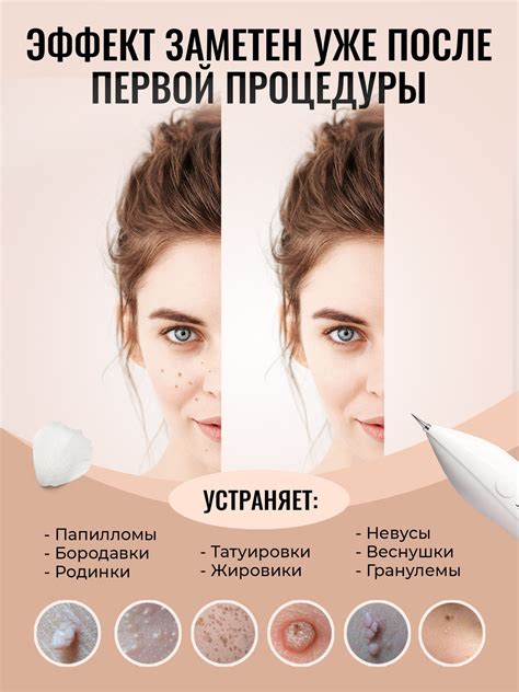 Лазерный терапевтический аппарат Лазерная ручка - купить по выгодной ...