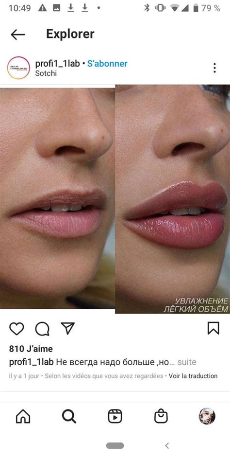 Pin on board | Botox lips, Lip fillers juvederm, Facial fillers