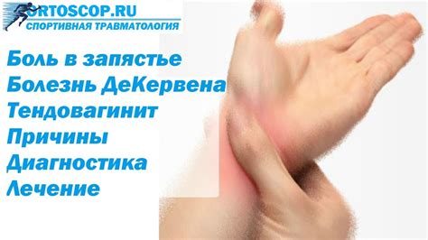 БОЛЬ В ЗАПЯСТЬЕ. БОЛЕЗНЬ ДеКЕРВЕНА. - YouTube