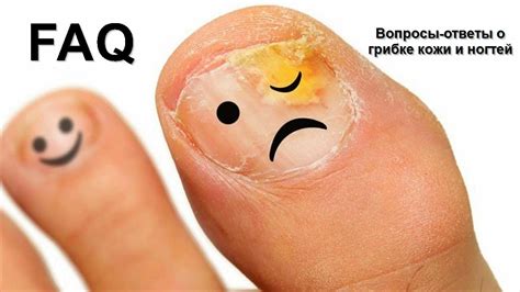 FAQ о грибке кожи и ногтей, вопросы и ответы