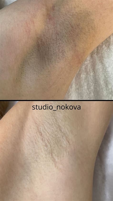 До/После | Лазерная эпиляция, Эпиляция, Косметология