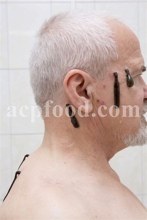 Leech Therapy - Treatment Of 111 Diseases | ACPFOOD