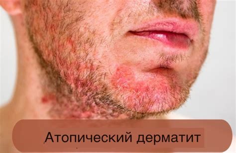 Ученые предоставляют новую информацию о лечении атопического дерматита