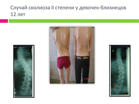 Профилактика и лечение нарушения осанки и сколиоза у детей ...
