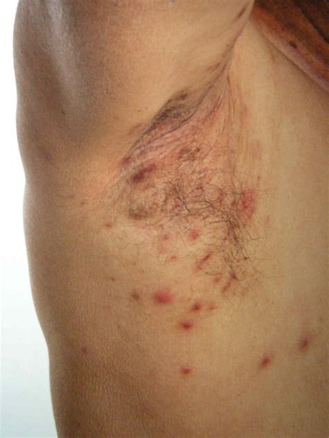 What Can Be Mistaken for Shingles? How 12 Other Rashes Compare