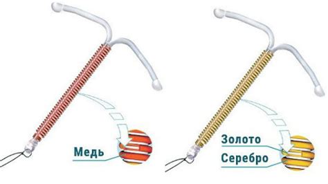 Внутриматочная спираль: её виды и установка. Внутриматочная спираль ...