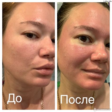 Что делать если после пилинга красное лицо