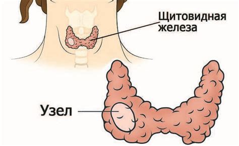 Узлы в щитовидной железе: симптомы и лечение