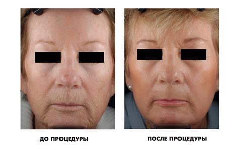 Rf лифтинг