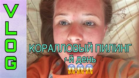 Коралловый пилинг - первый день * Припухла малость - YouTube