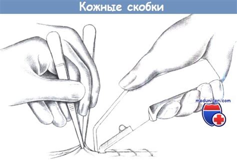Виды и техника наложения кожных швов