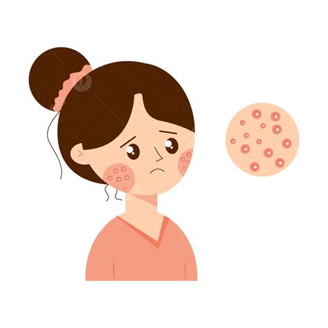 Vector Illustration Of Woman With Acne Skin Type, Acne, Acne Face, Skin ...