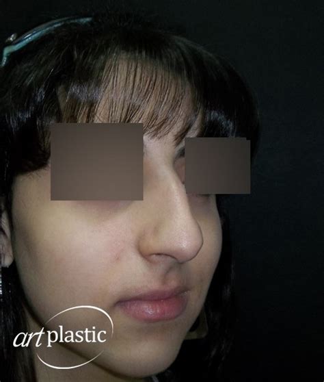 Большой, горбатый нос / Фото / Альбом №59 | Клиника Art-Plastic