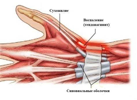 Тендовагинит сустава - Первая Медицинская Клиника