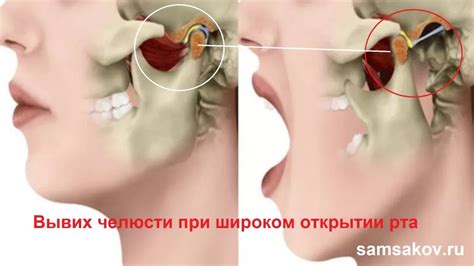 Что делать при вывихе челюсти: рекомендации и первая помощь | Альянс ...