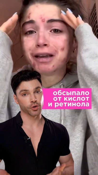 Прыщи от ретинола и кислот ! - YouTube