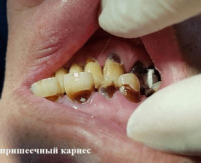 Ирригатор — прибор для эффективного удаления загрязнений из тех зон ...