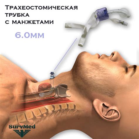 Трахеостомическая трубка с манжетами, 6.0мм