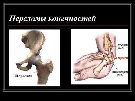 Переломы. Классификация - презентация онлайн