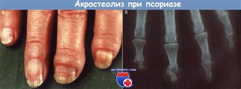 Причины изменения форм пальцев (акростеолиза)