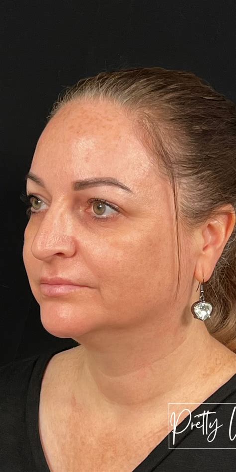 Full Face Filler - Pretty Little Lies Aesthetics
